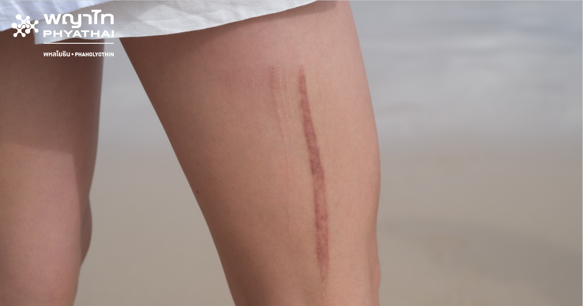 Raised scars and keloid scars: Causes, treatments, and prevention ...